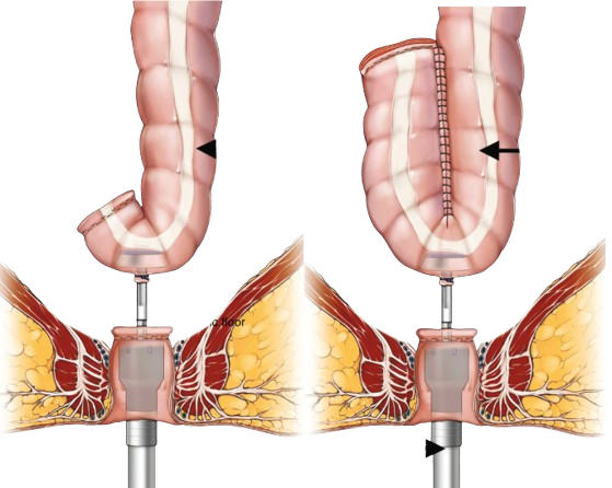 Laparoscopic Colorectal Resection