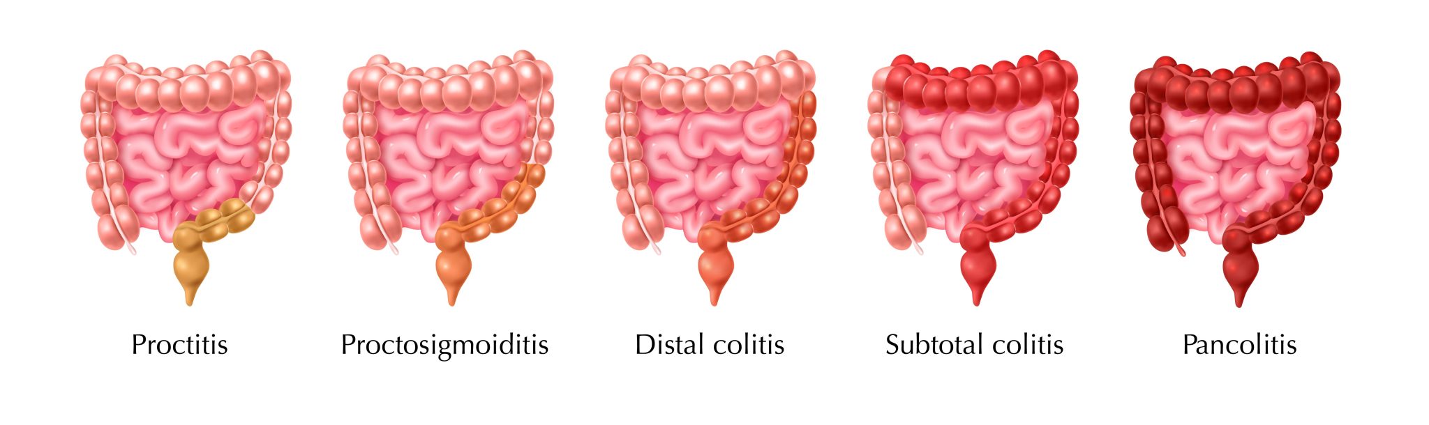 Rectal Resection